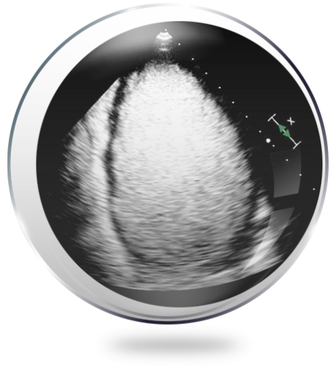 LUMASON Ultrasound Enhancing Agent High Clarity Very Low MI Signal to Noise Ratio - LUMASON