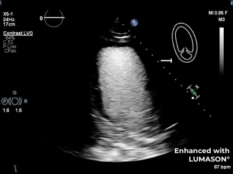 61-year-old female with CAD and left main stent - LUMASON